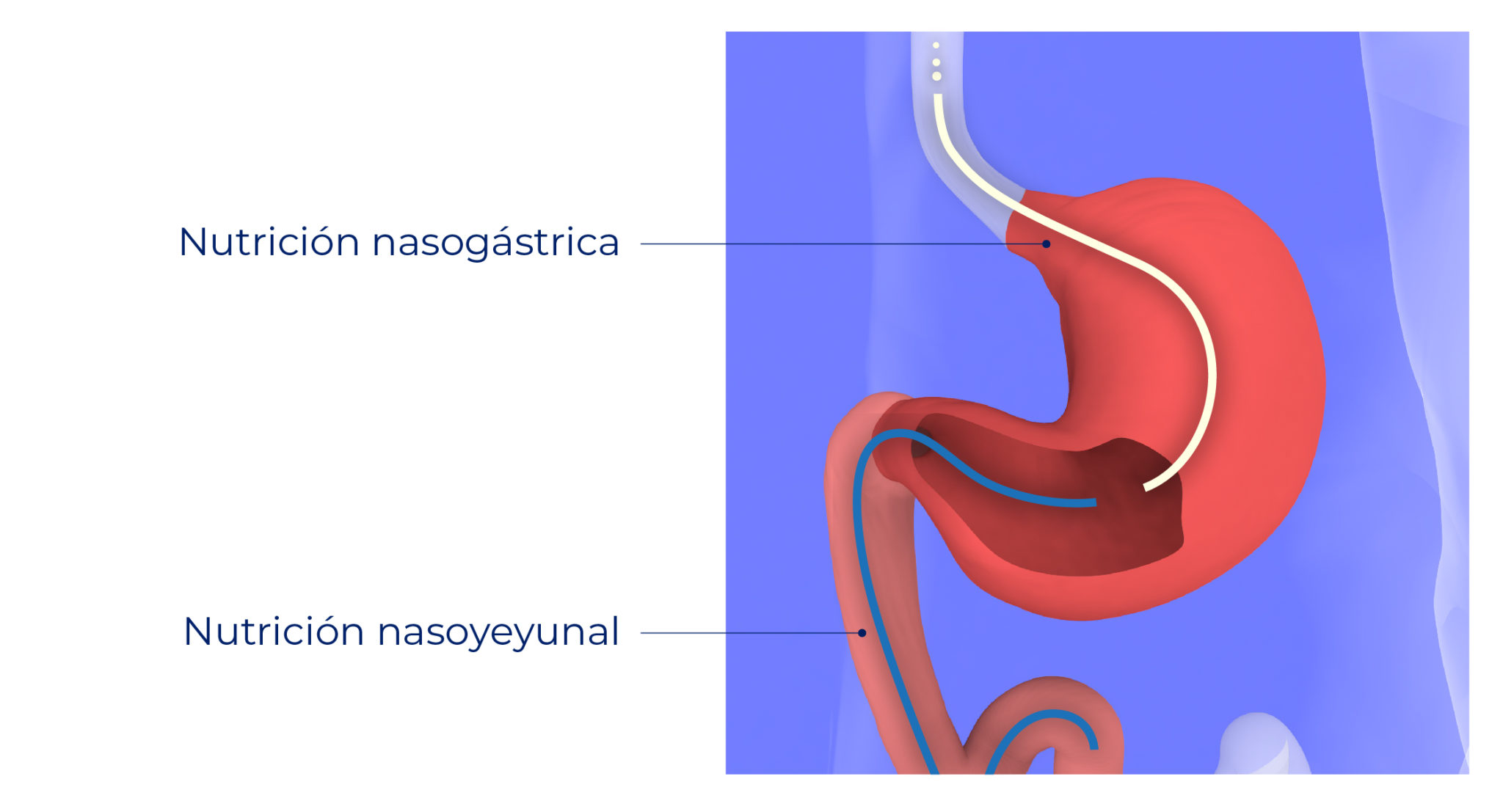 Guía para elegir la sonda nasogástrica adecuada | Compat