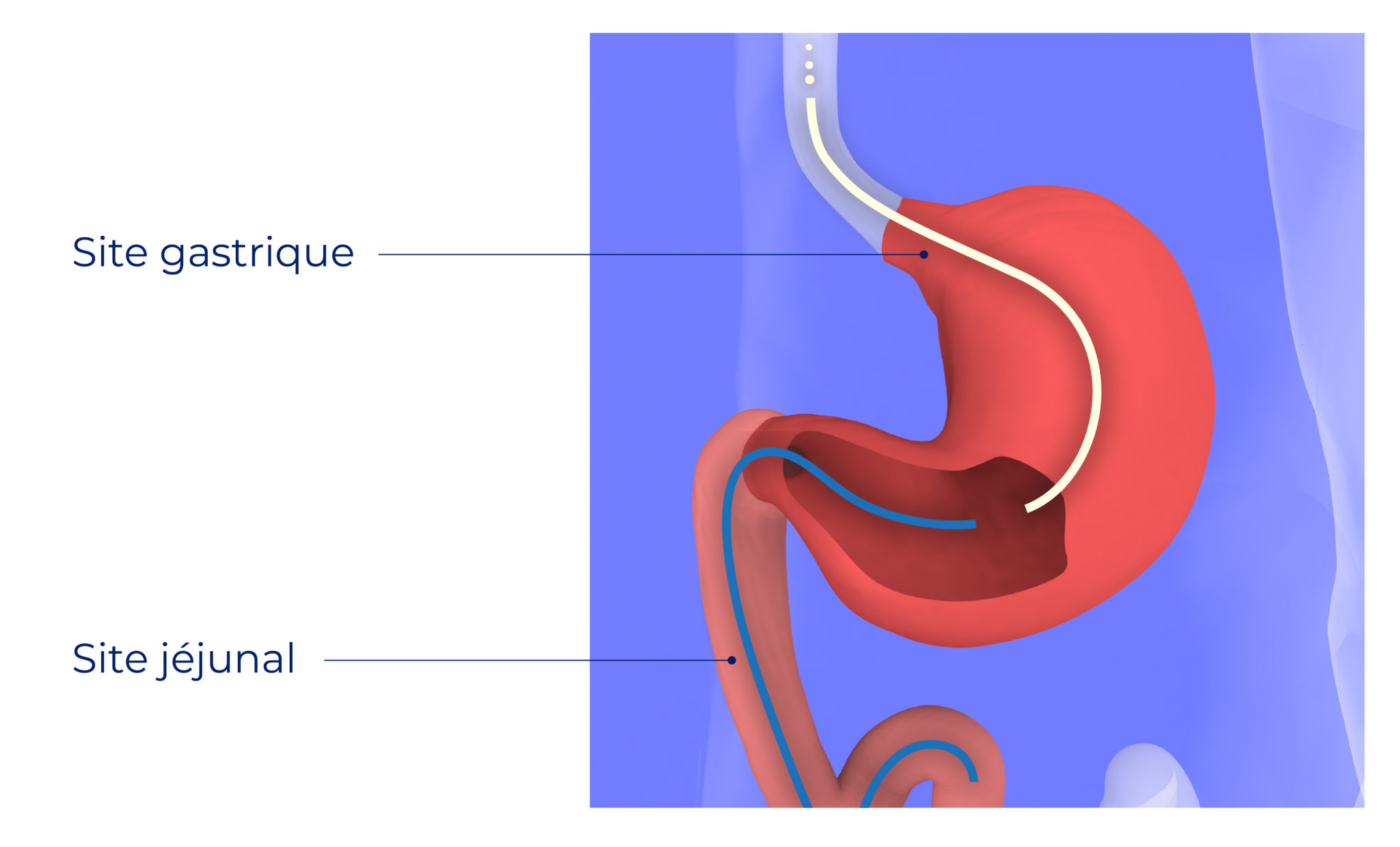 Un guide pour sélectionner la sonde nasogastrique appropriée | Compat